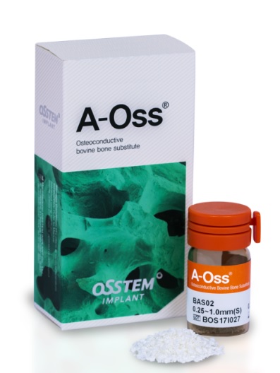 오스템 이종골 이식재 ‘A-Oss 라인’ 인기비결 - 헬스케어N - 헬스조선,헬스케어엔